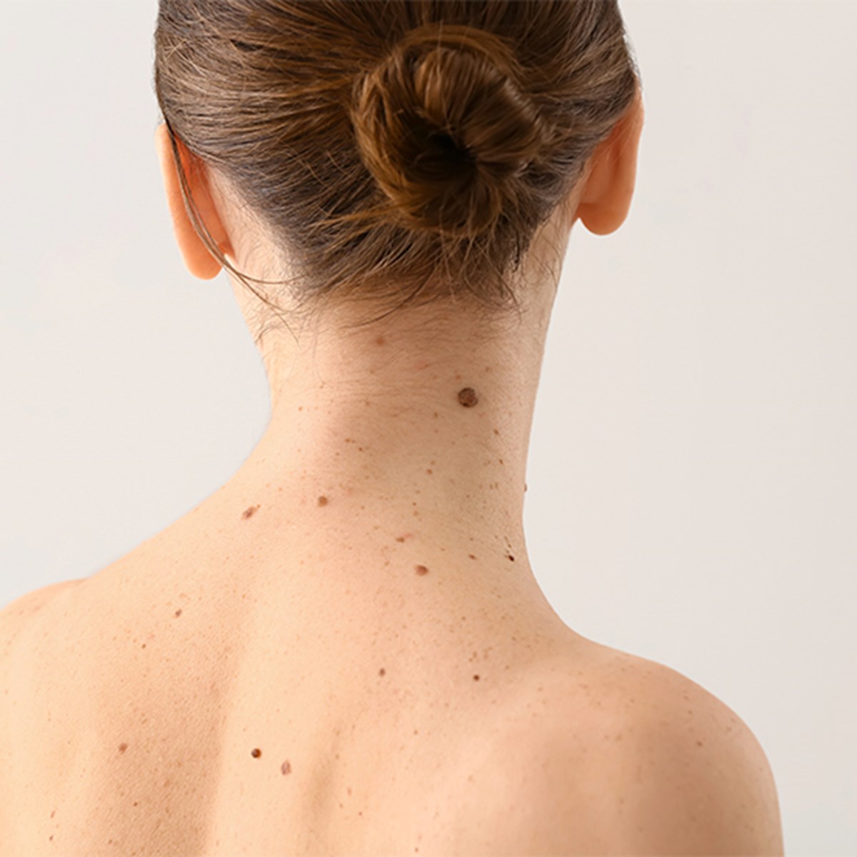 Muttermale: Ein Dermatologe klärt uns darüber auf