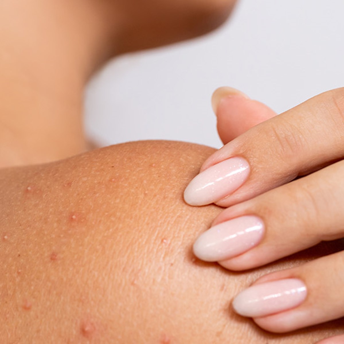 Hitzepickel verstehen und vorbeugen: Eine Dermatologin klärt auf